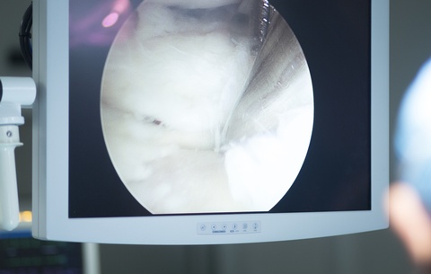 Know more about an arthroscopy of a frozen shoulder