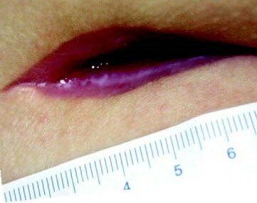 Pilonidal Sinus Wound Self-Care Wound Dressing Guide